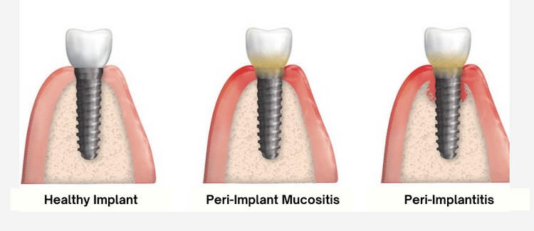 Peri-Implant Disease – Hydro Floss®