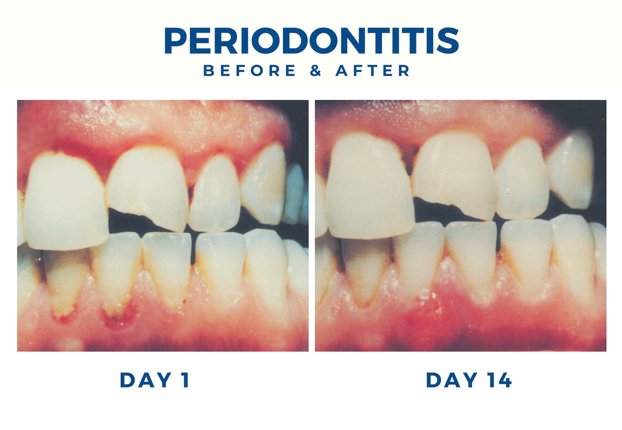 Hydro Floss® Oral Irrigator