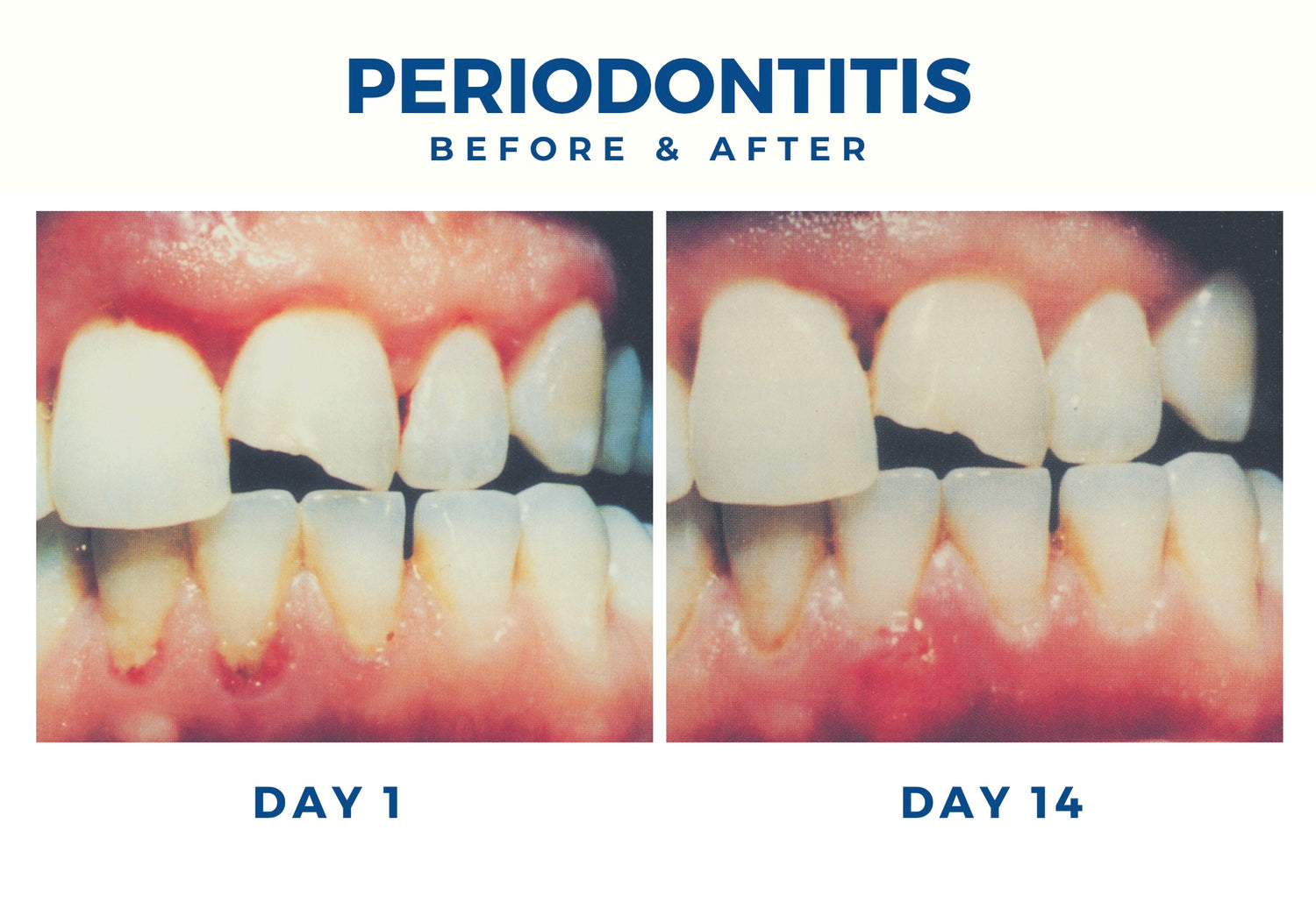 Hydro Floss® Oral Irrigator