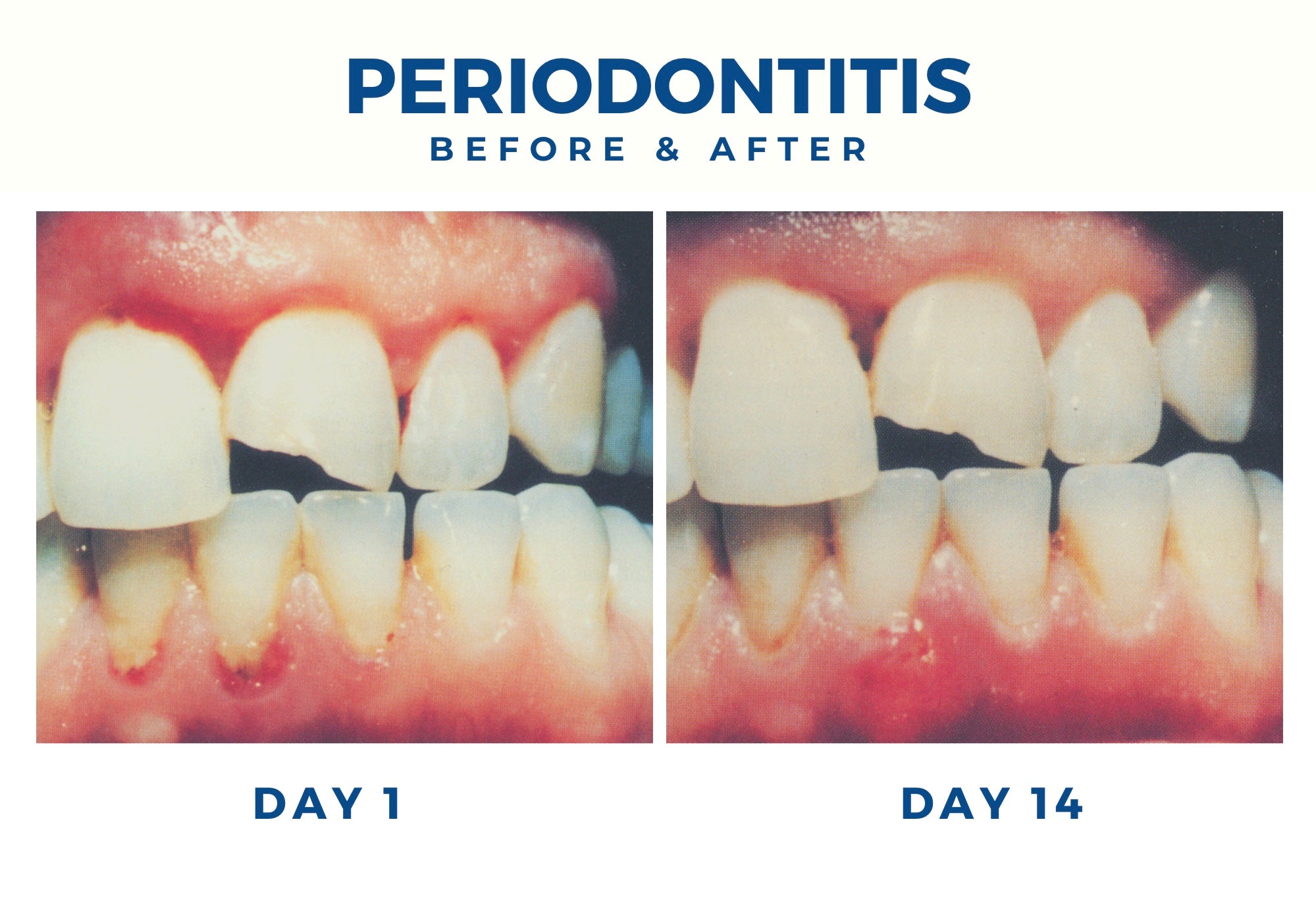 Hydro Floss® Oral Irrigator