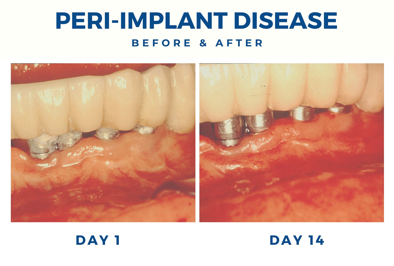 Hydro Floss® Oral Irrigator
