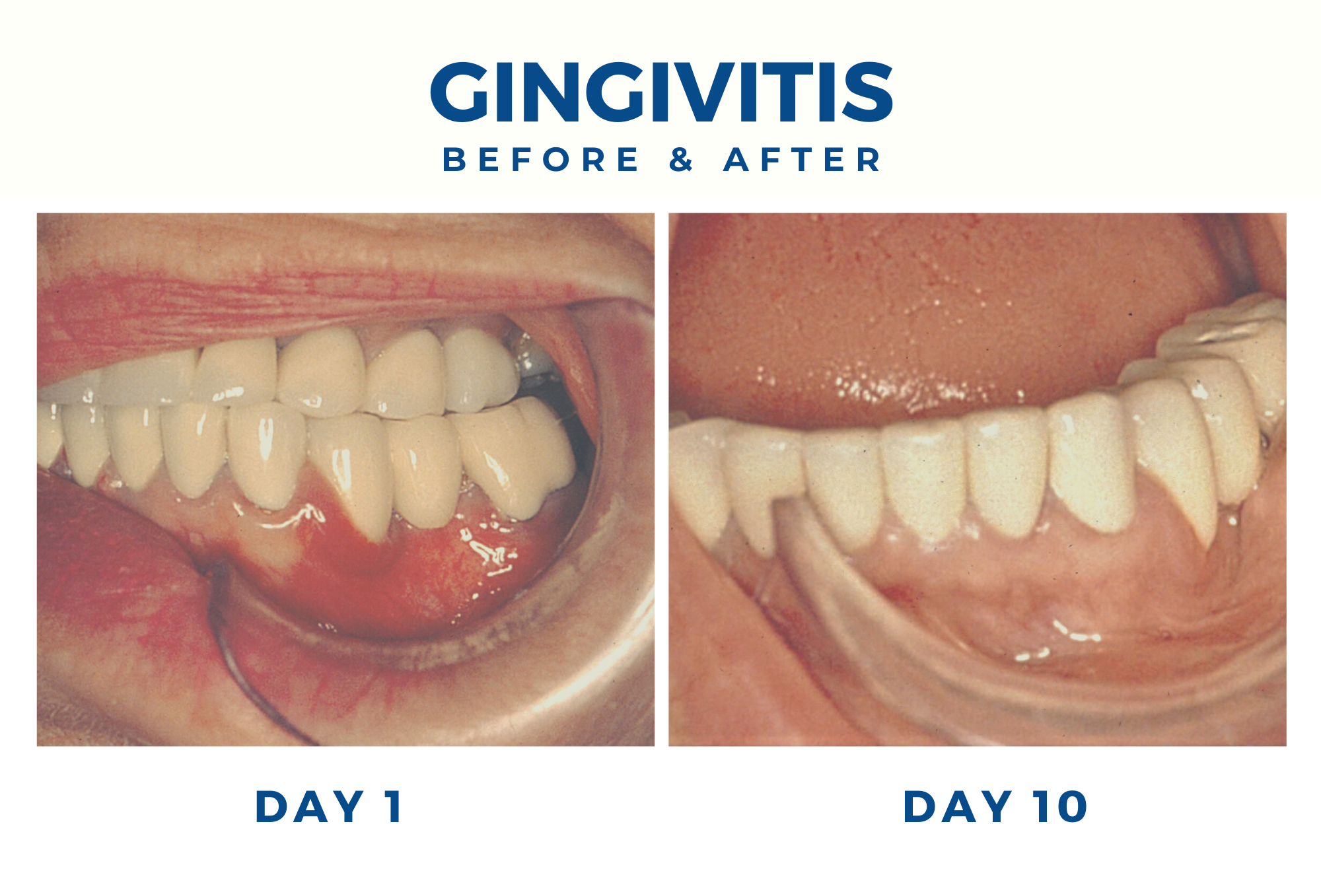 Hydro Floss® Oral Irrigator